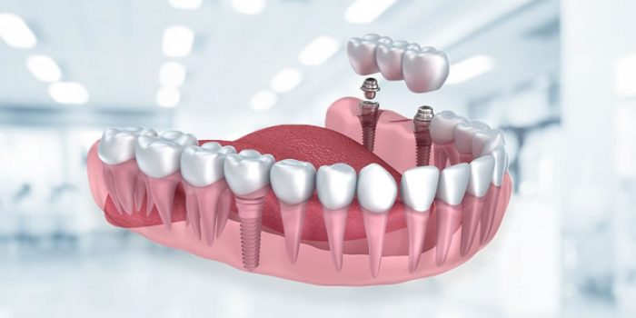 How is Implant Clinical Examination Performed? | Emident Dental Clinic